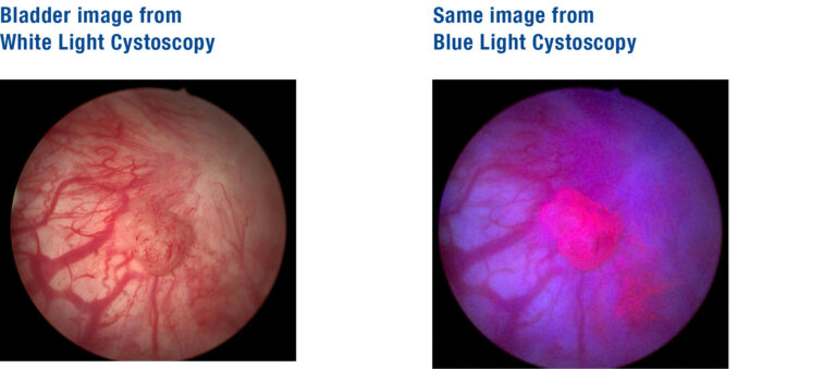 Blue Light Cystoscopy - ForTec Medical